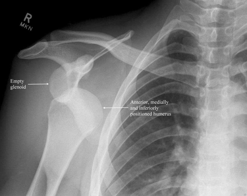 Shoulder Instability (Recurrent Dislocation) – speedhospitals.com